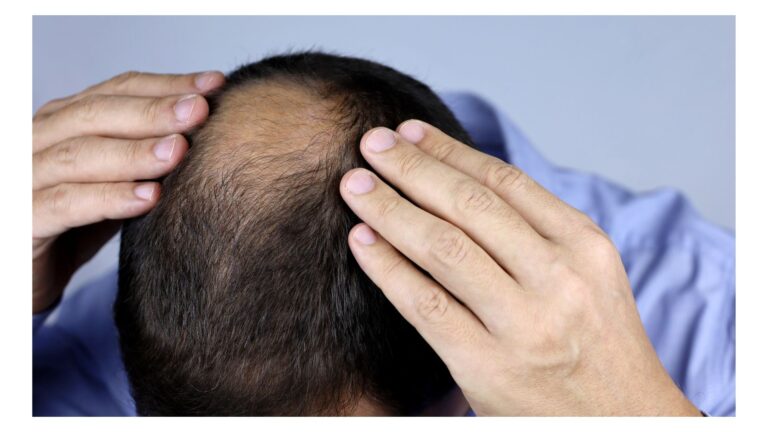 Could PP405 Be the Breakthrough for Baldness? - IK Clinics